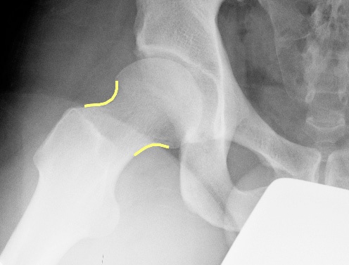 Femoro-Acetabular Impingement (FAI) FAQs | Hip and Pelvis | Doctor ...