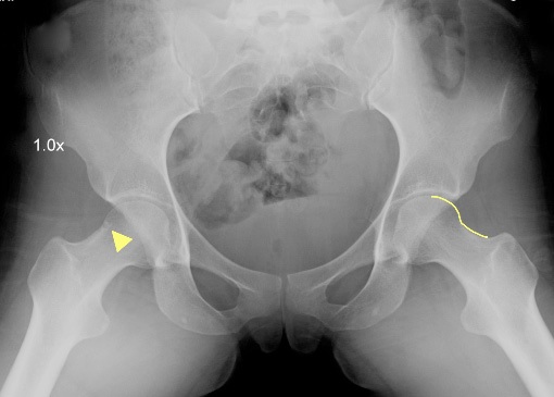 Femoro-Acetabular Impingement (FAI) FAQs | Hip and Pelvis | Doctor ...