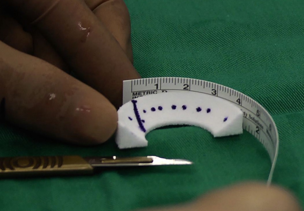 Meniscal Regeneration By Meniscal Scaffold Implant Actifit Polyurethane ...