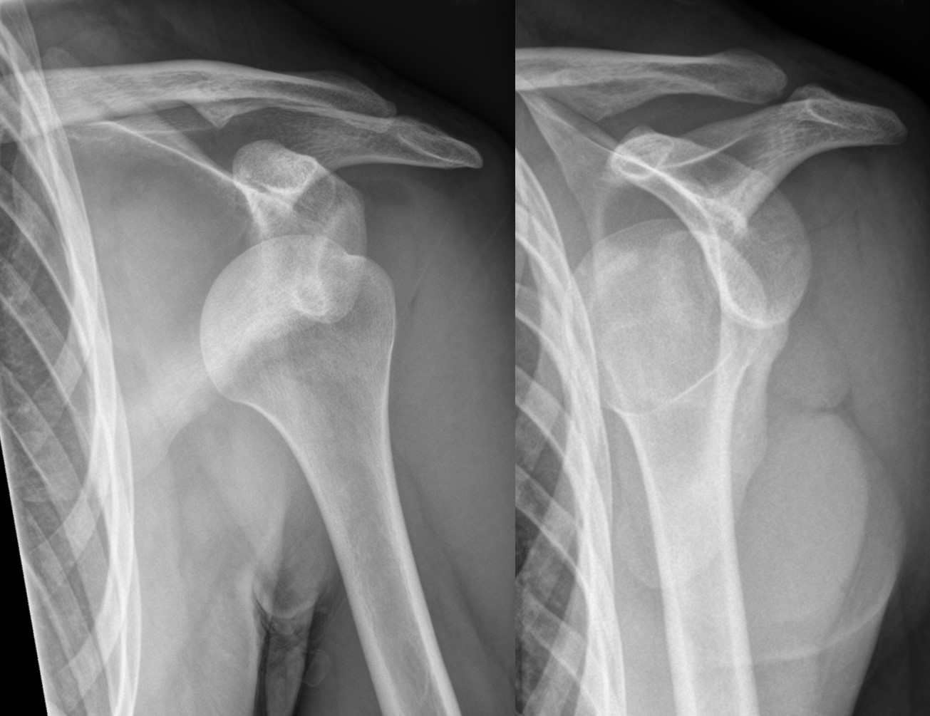 Shoulder Dislocation FAQs | Shoulder | Doctor Articles | Asia Medical ...
